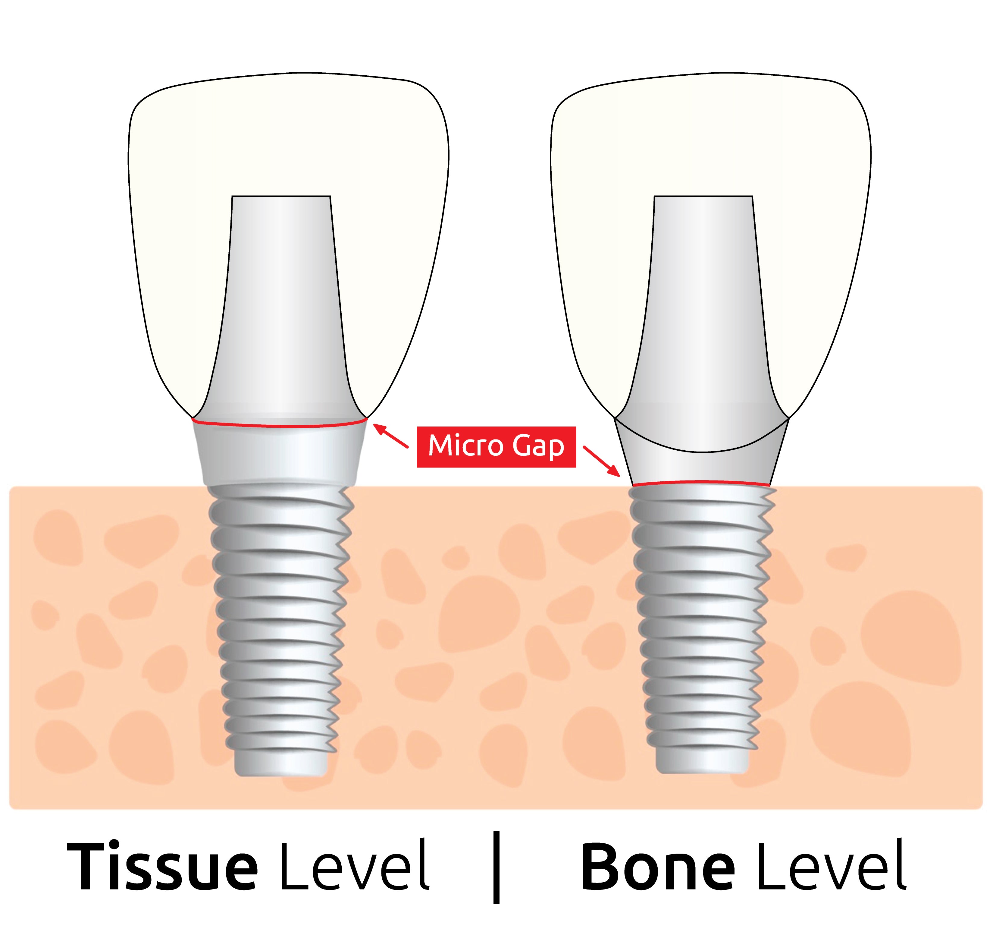 Dental Implants Showdown: Bone-Level vs Tissue-Level