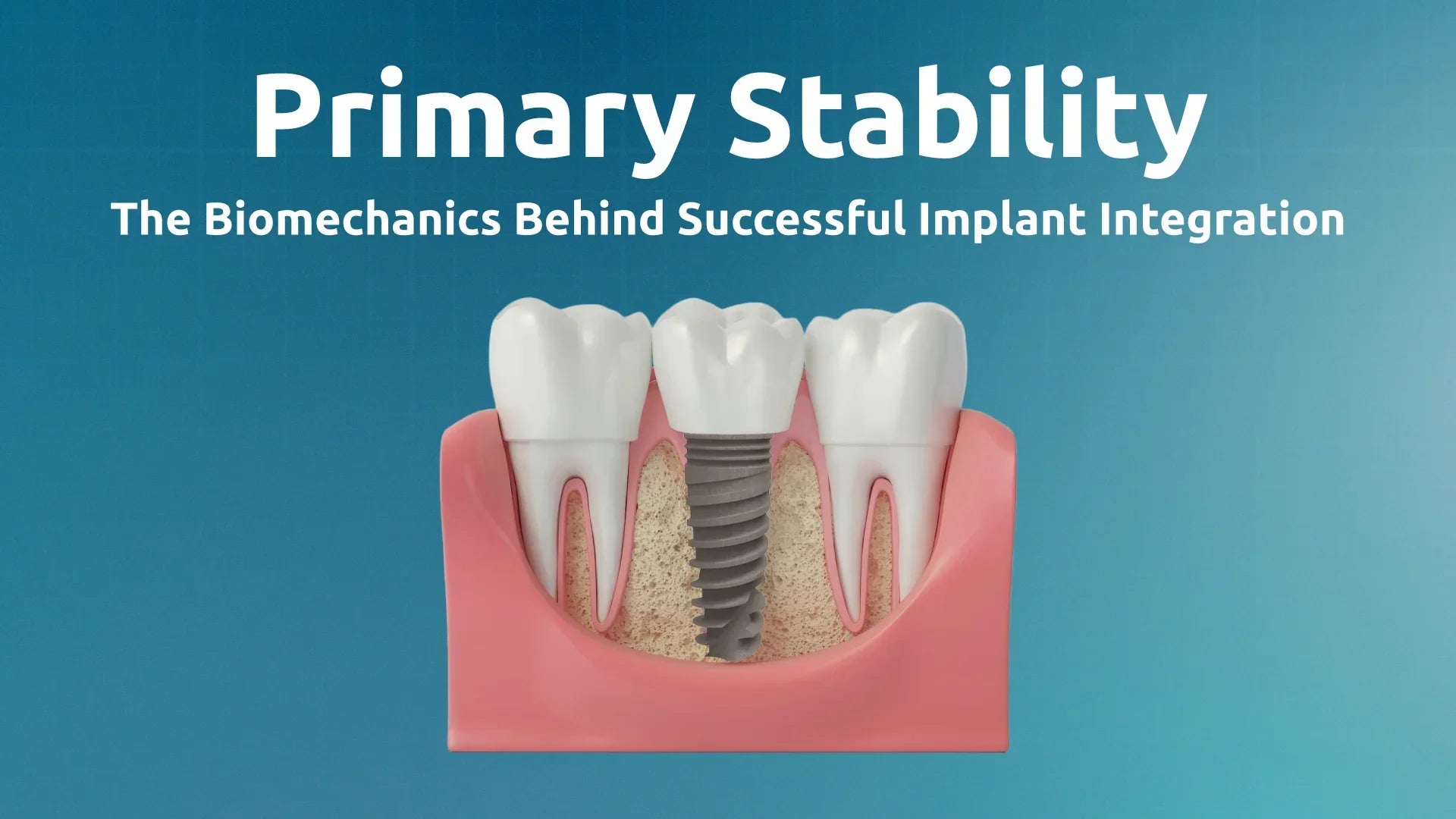 Primary Stability: The Biomechanics Behind Successful Implant Integrat
