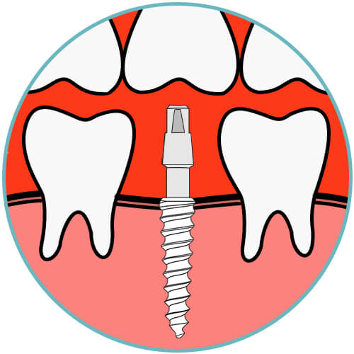 One Piece Implants | GDT Implants - Dental Implants and Supplies